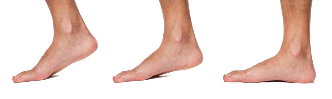 Problems from having flat feet | Family Foot & Ankle Centers